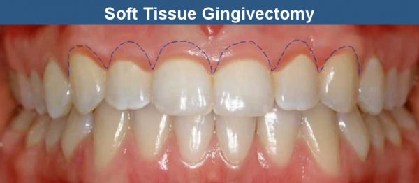 gingivectomy procedure - Dr. Natalya Carmichael General & Cosmetic ...