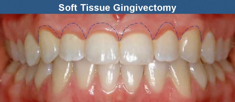 gingivectomy procedure - Dr. Natalya Carmichael General & Cosmetic ...